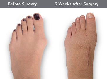 Lapiplasty - Foot and Ankle Centers of North Houston